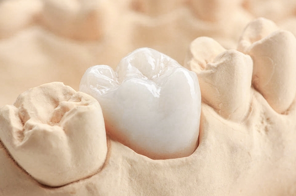 Inlays/Onlays in Mexico | Partial Crowns Costs | Zirconia・Emax