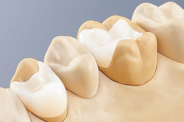Inlays/Onlays in Mexico | Partial Crowns Costs | Zirconia・Emax